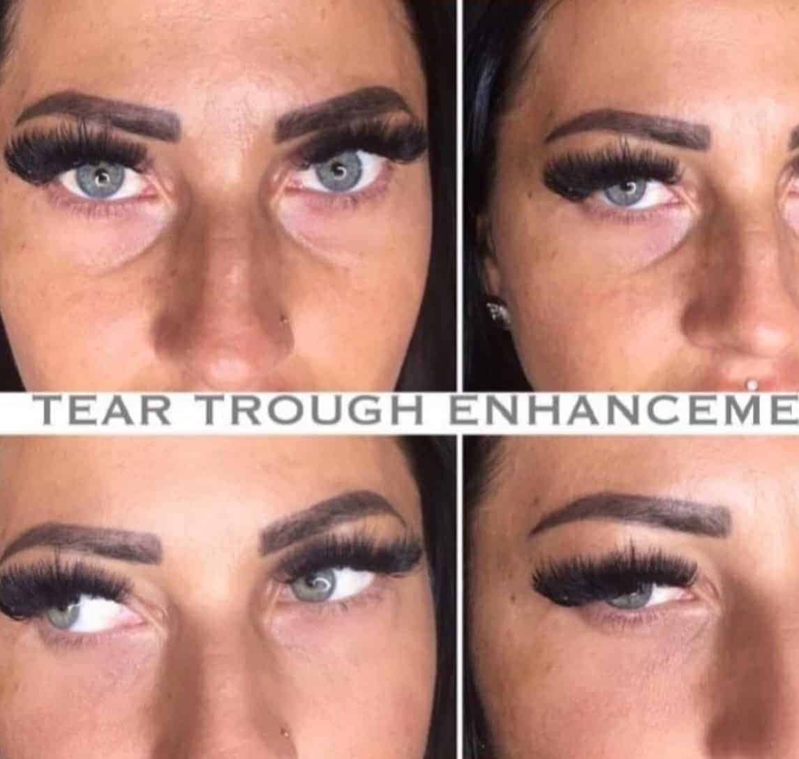 Side Effects Of Tear Trough Filler - Belle Clinic London