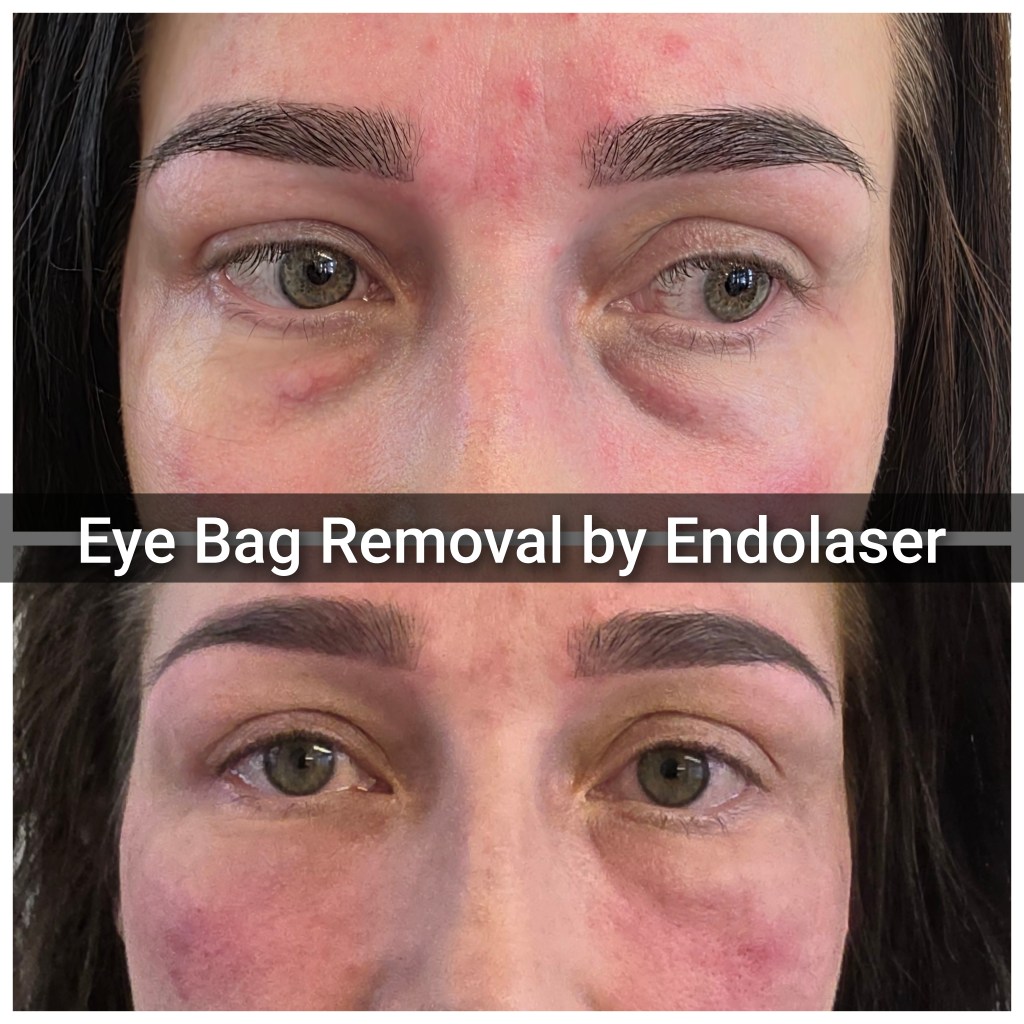 #1 Best Endolift Laser Facelift | Belle Clinic London, UK